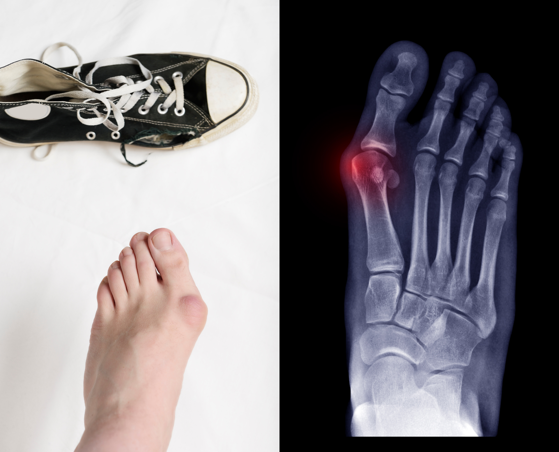 The Barefoot Series, Part Two. Bunions. - diybarefootshoes.comdiybarefootshoes.com